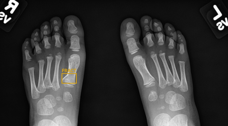 St. Luke’s adopts AI tool to improve detection of bone trauma in X-rays ...